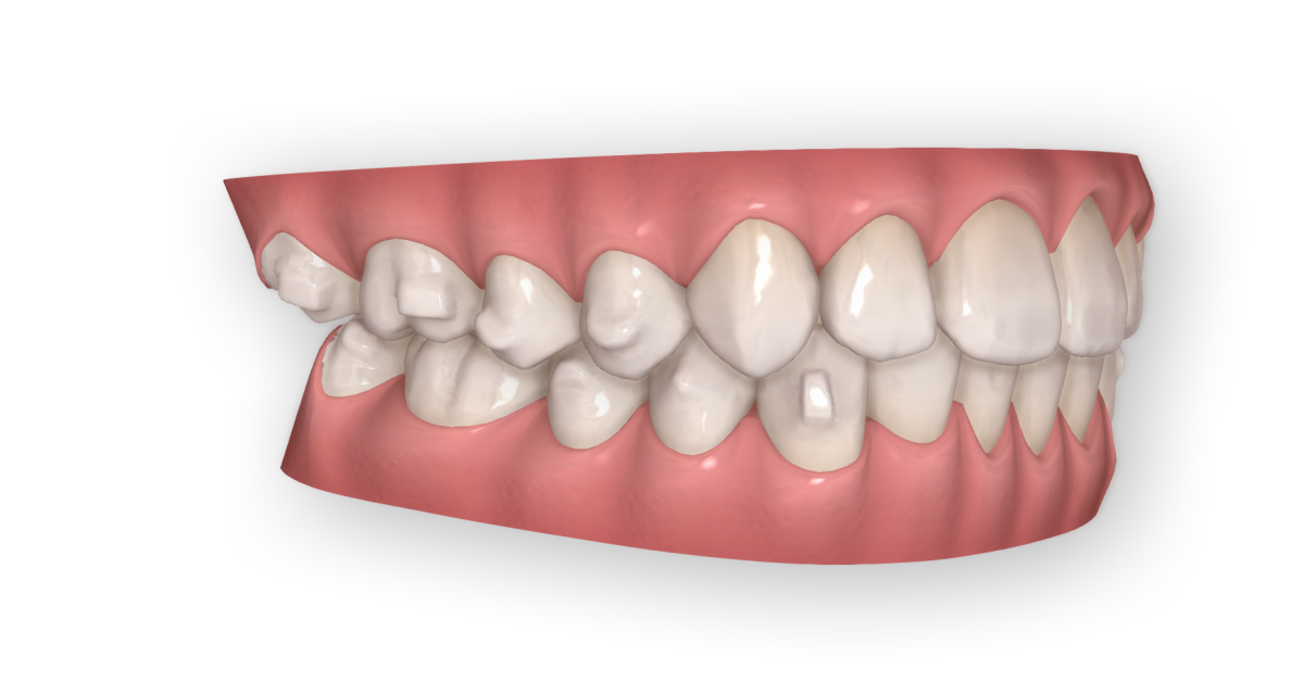 Der richtige Dreh: Attachments in der Aligner-Behandlung - Aktuelle ...