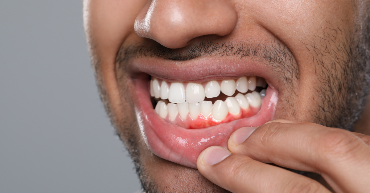 Gesundes Zahnfleisch: der Schlüssel zu einem strahlenden Lächeln