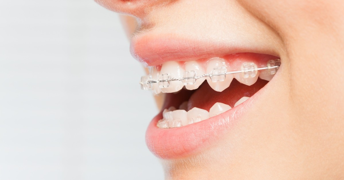 Kein Hingucker: Keramikbrackets - medondo.health